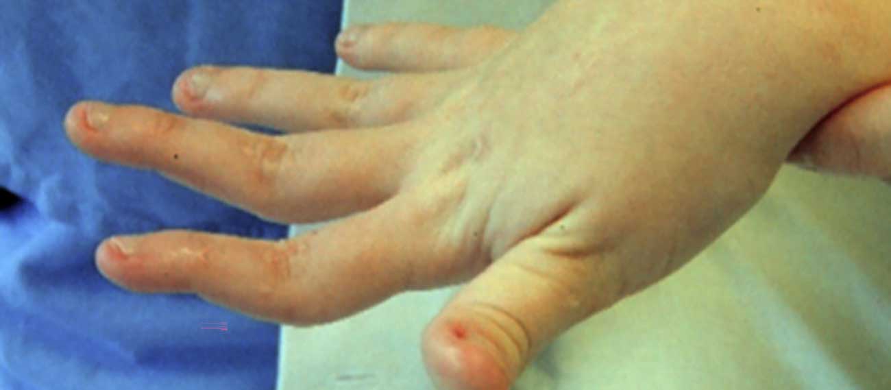 Swan Neck Deformity - Mayfair Wellness Clinic